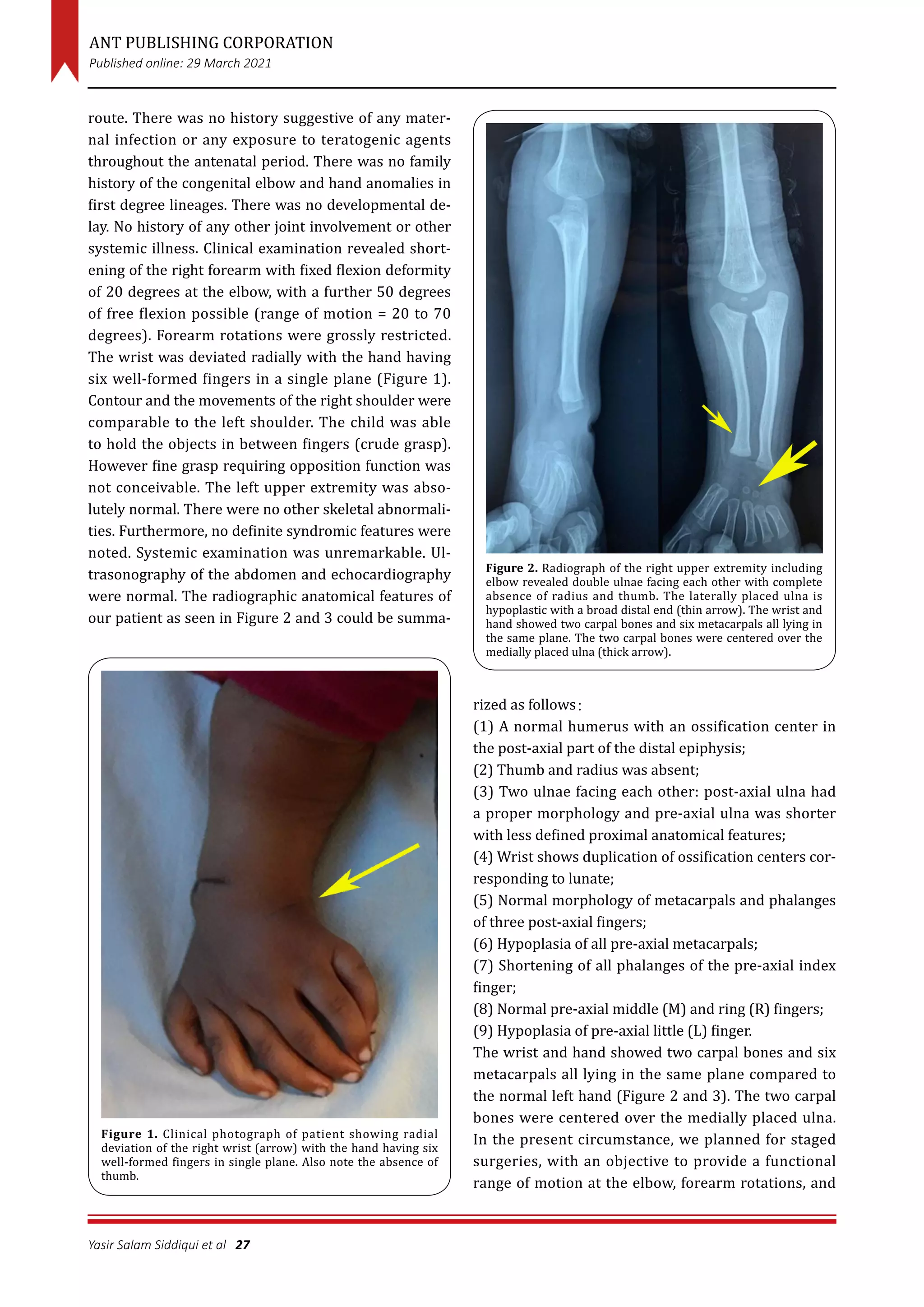 Ulnar dimelia – a rare and neglected anomaly of upper extremity | PDF