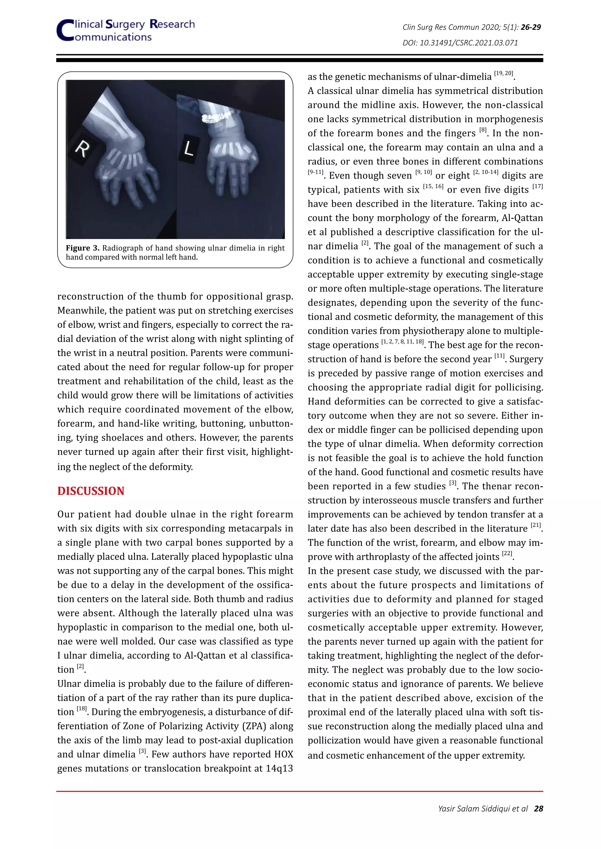 Ulnar dimelia – a rare and neglected anomaly of upper extremity | PDF