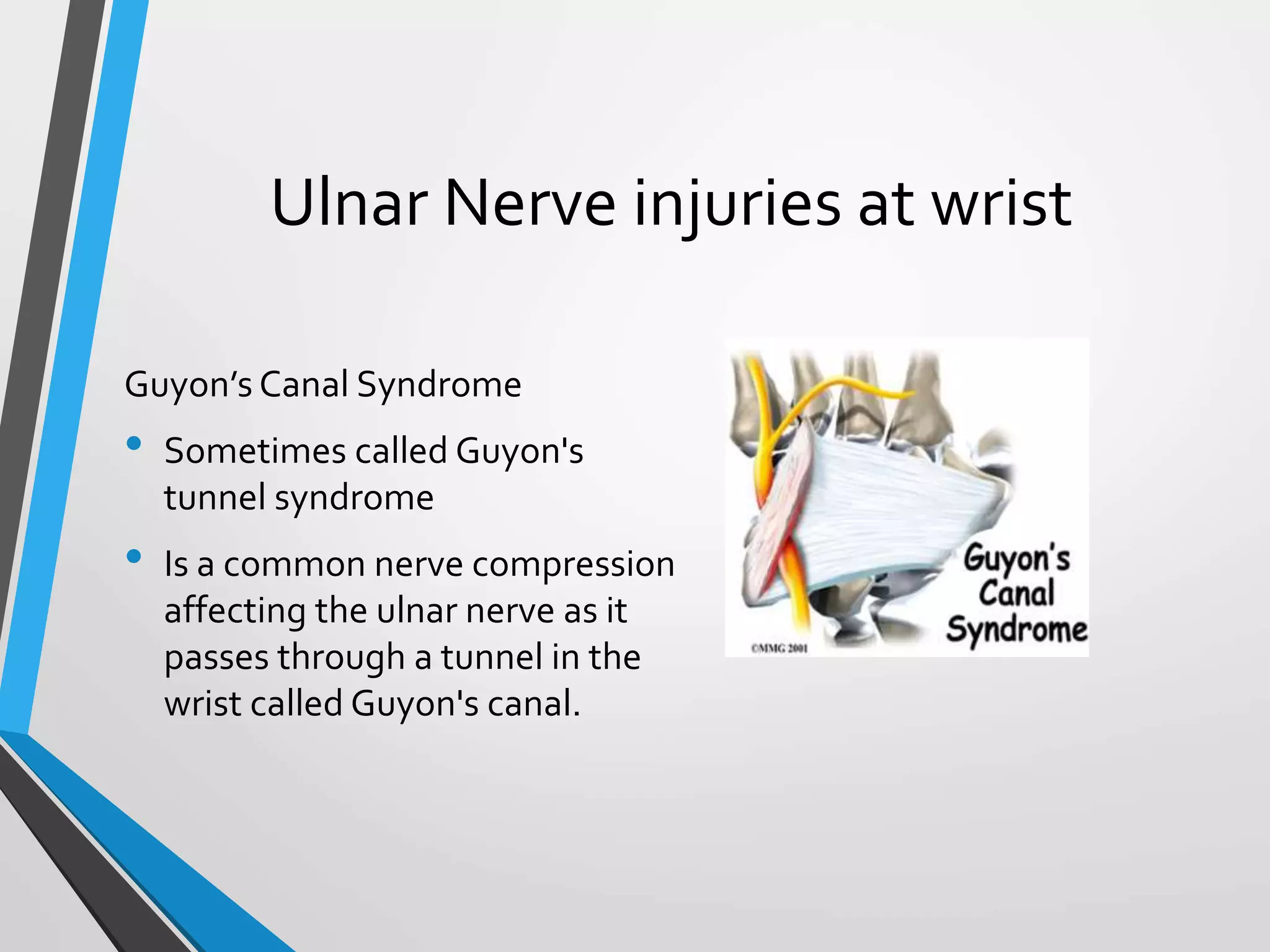 Ulnar Nerve and clinical features | PPTX