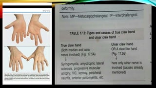 Ulnar Nerve Injury Claw Hand
