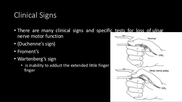 Ulnar nerve laceration