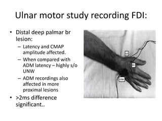 Ulnar neuropathy at wrist- Electrophysiological approache | PPT