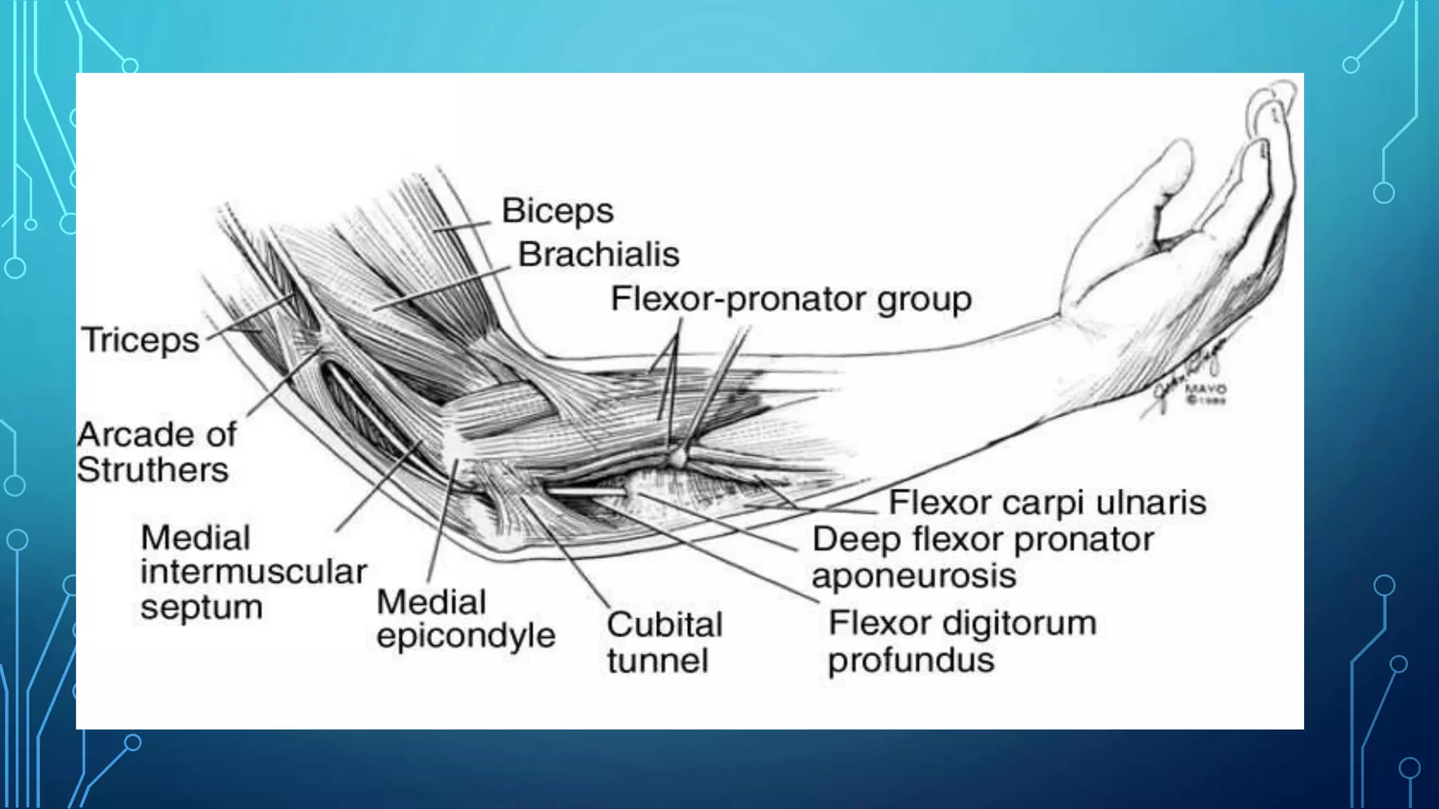 Ulnar Tunnel Syndrome (Cubital Tunnel Syndrome).pptx