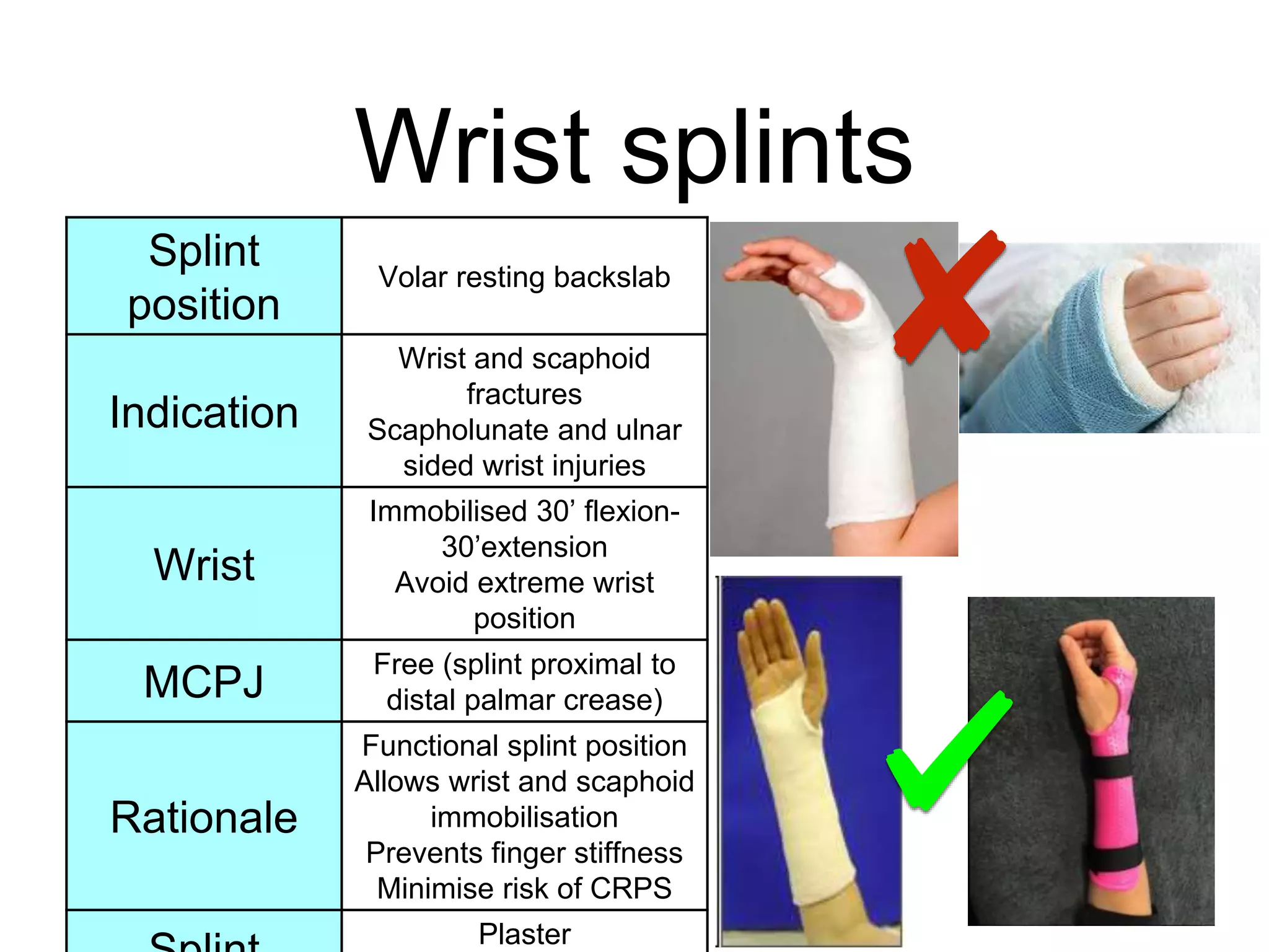 Upper limb splinting workshop | PPTX