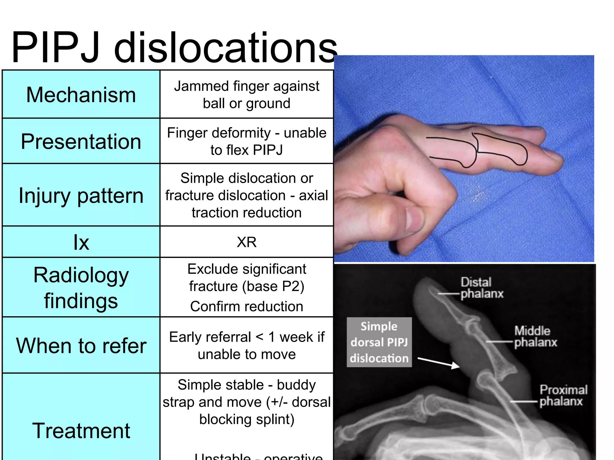Upper limb splinting workshop | PPTX