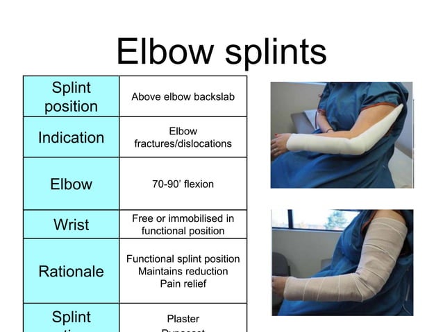 Upper limb splinting workshop | PPTX