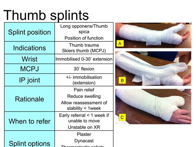 Upper limb splinting workshop | PPTX