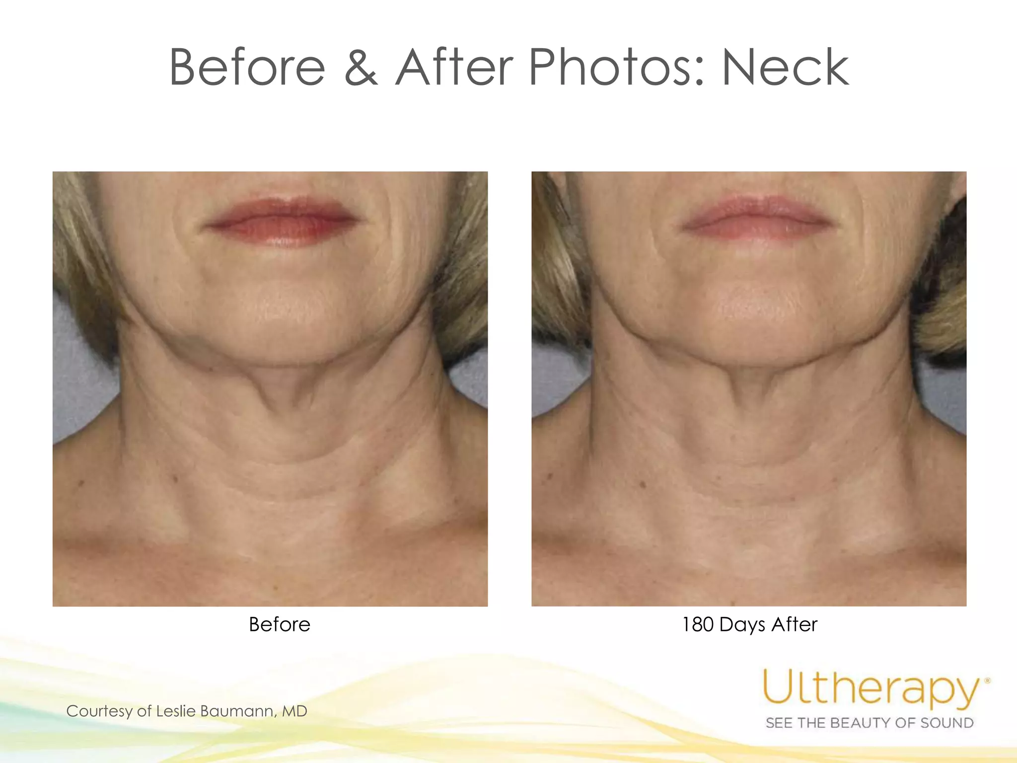 Ultherapy: The First-ever, FDA- approved, Noninvasive, Skin-lifting ...