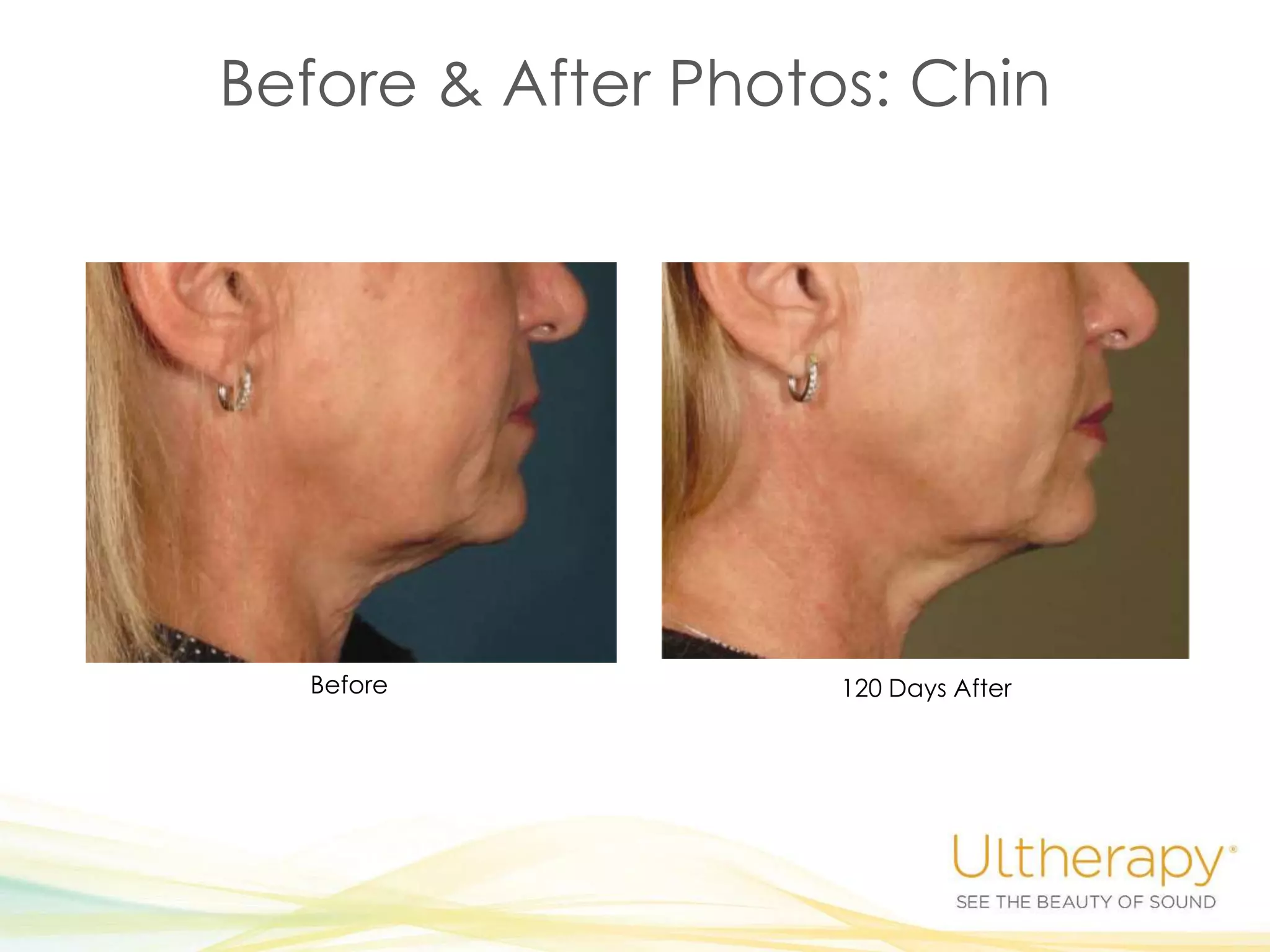 Ultherapy: The First-ever, FDA- approved, Noninvasive, Skin-lifting ...