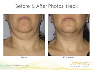 Ultherapy: The First-ever, FDA- approved, Noninvasive, Skin-lifting ...