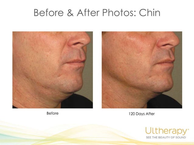 Ultherapy: The First-ever, FDA- approved, Noninvasive, Skin-lifting ...