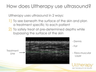 Ultherapy: The First-ever, FDA- approved, Noninvasive, Skin-lifting ...
