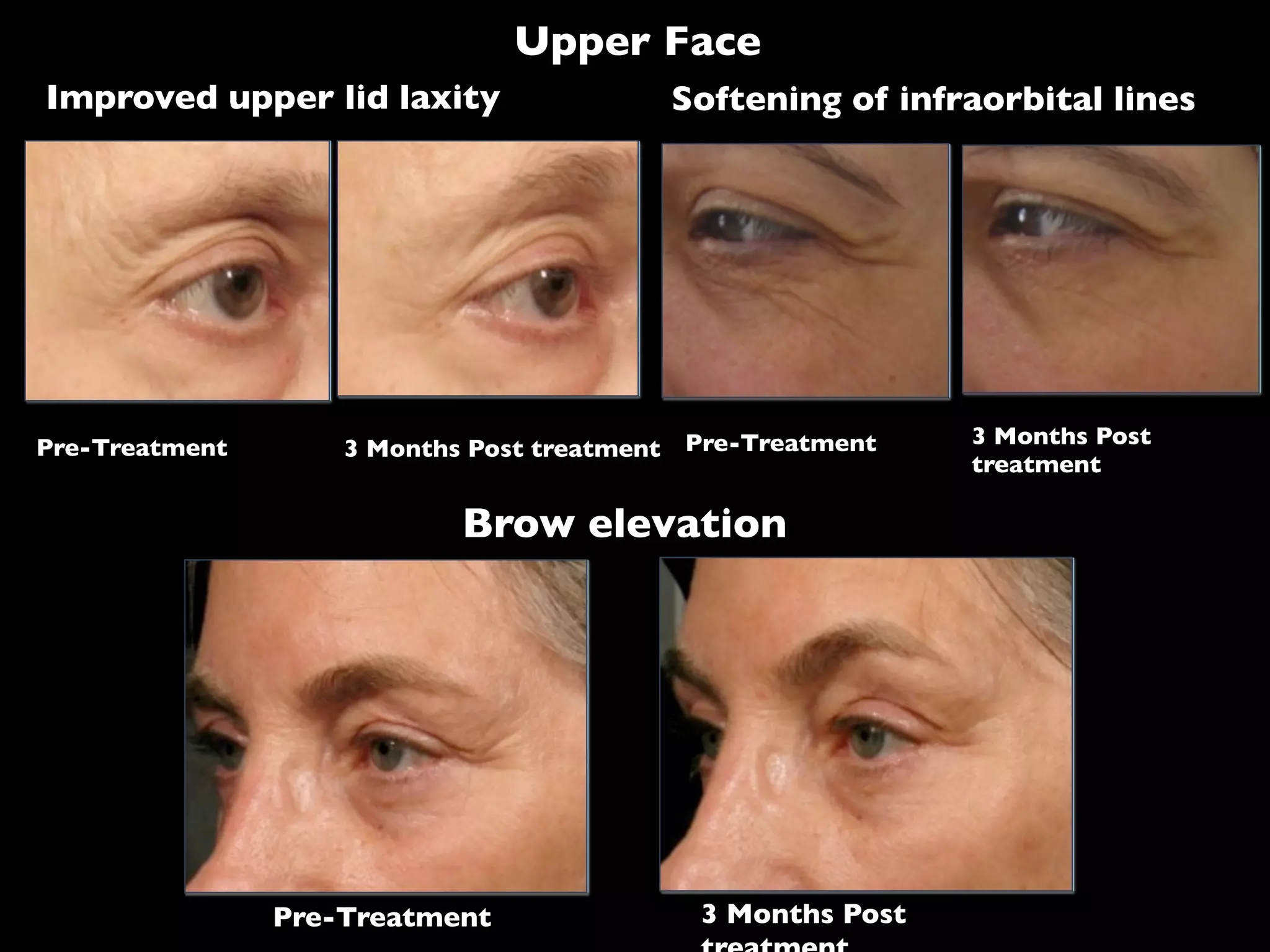 Ulthera - before & after pictures | KEY