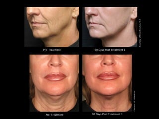 Ulthera - before & after pictures | KEY | Skin Care | Beauty