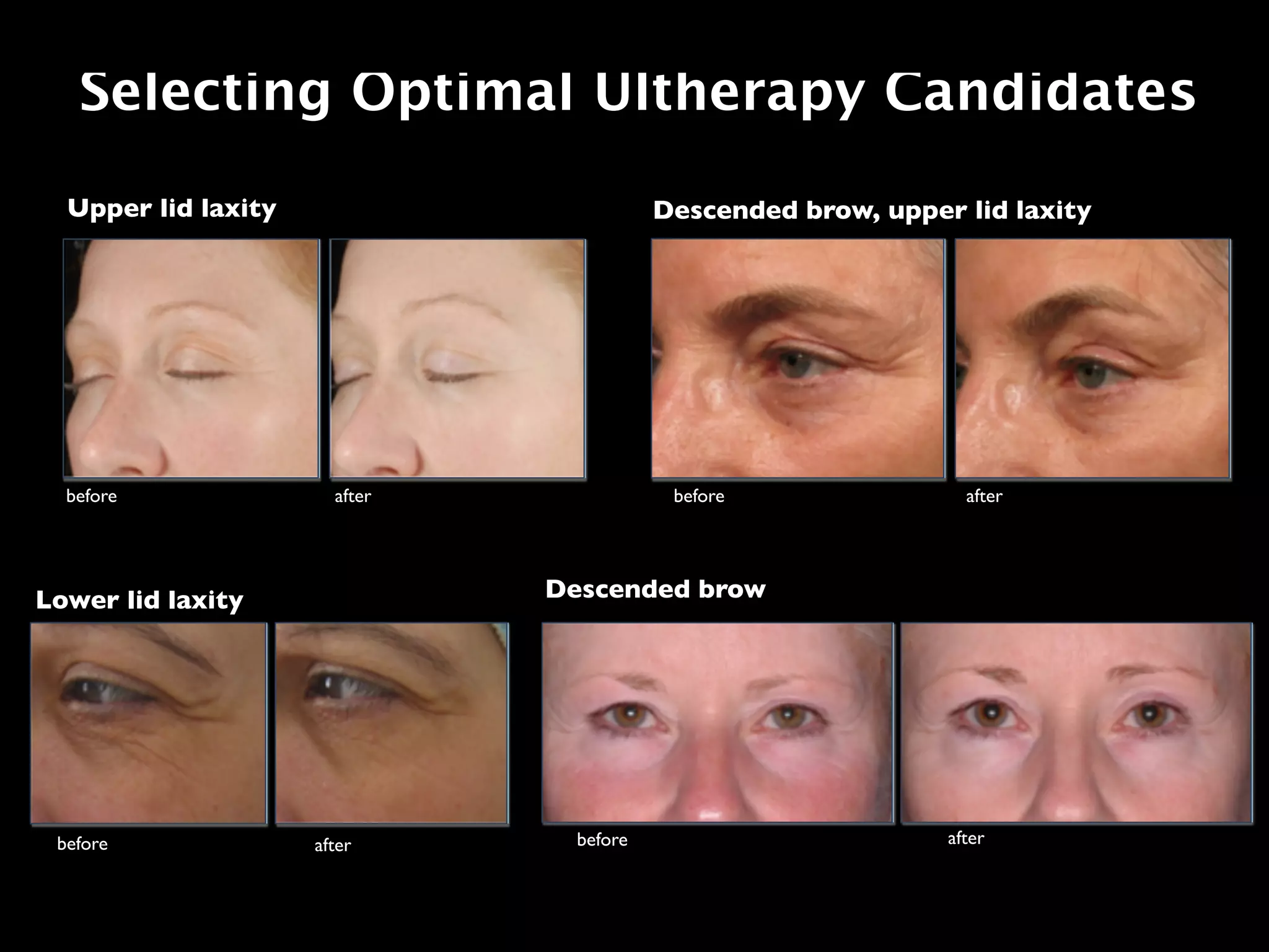 Ulthera - Optimal Candidates | KEY | Cosmetic Medical Services ...