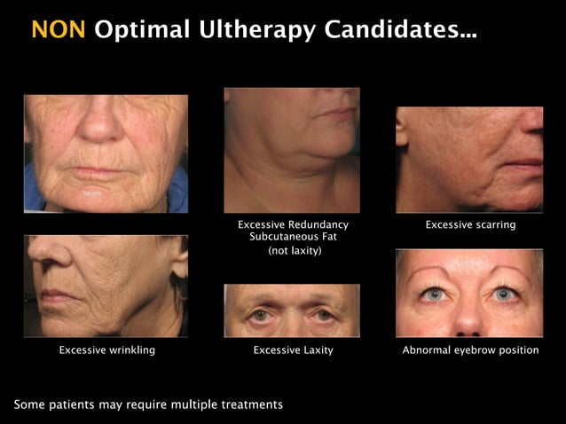 Ulthera - Optimal Candidates | KEY | Cosmetic Medical Services ...