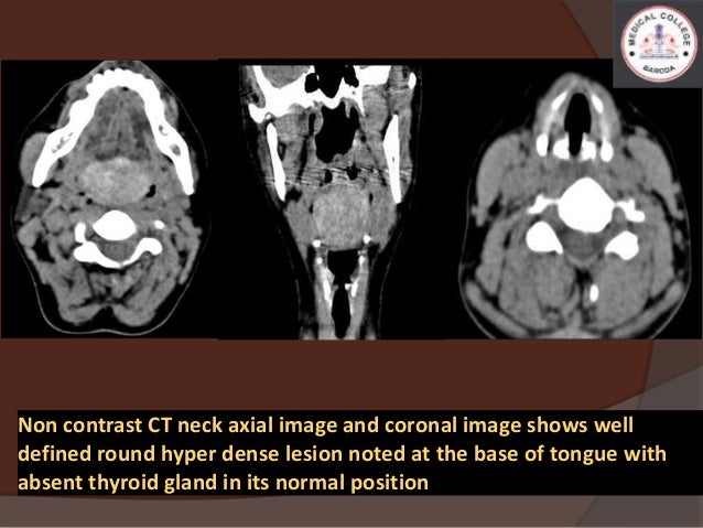 The Tongue And Thyroid Disease