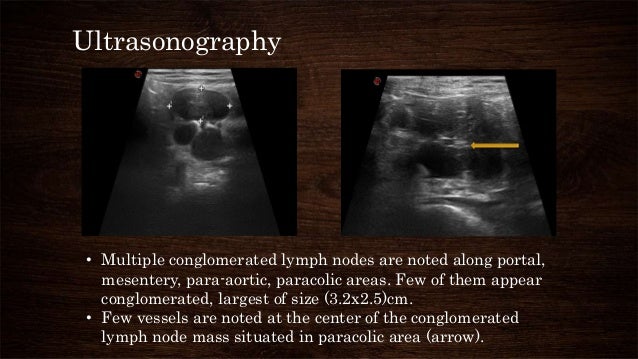 Ultrafest sandwich sign