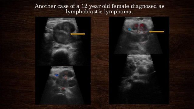 Ultrafest sandwich sign