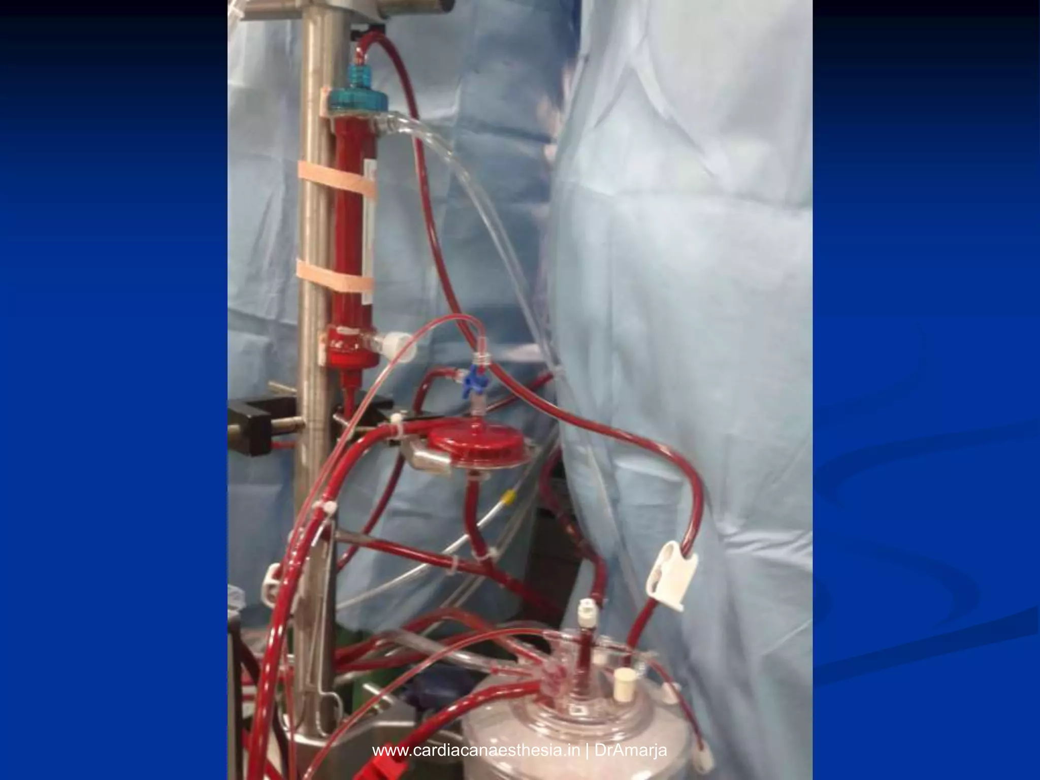 Ultrafiltration during cardiopulmonary_bypass | PPSX