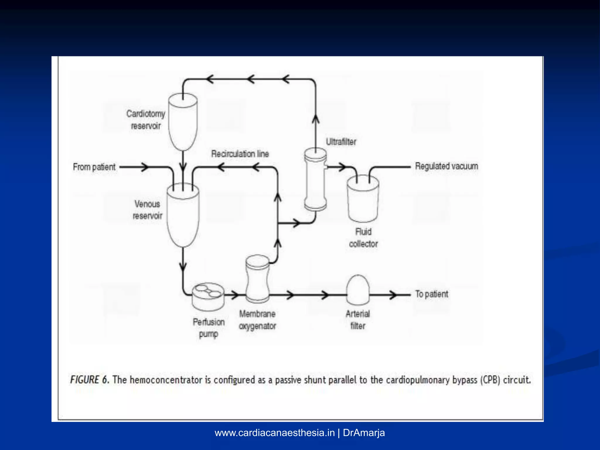 Ultrafiltration during cardiopulmonary_bypass | PPSX
