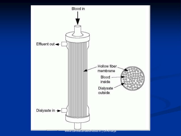 Ultrafiltration during cardiopulmonary_bypass | PPSX | Heart and ...