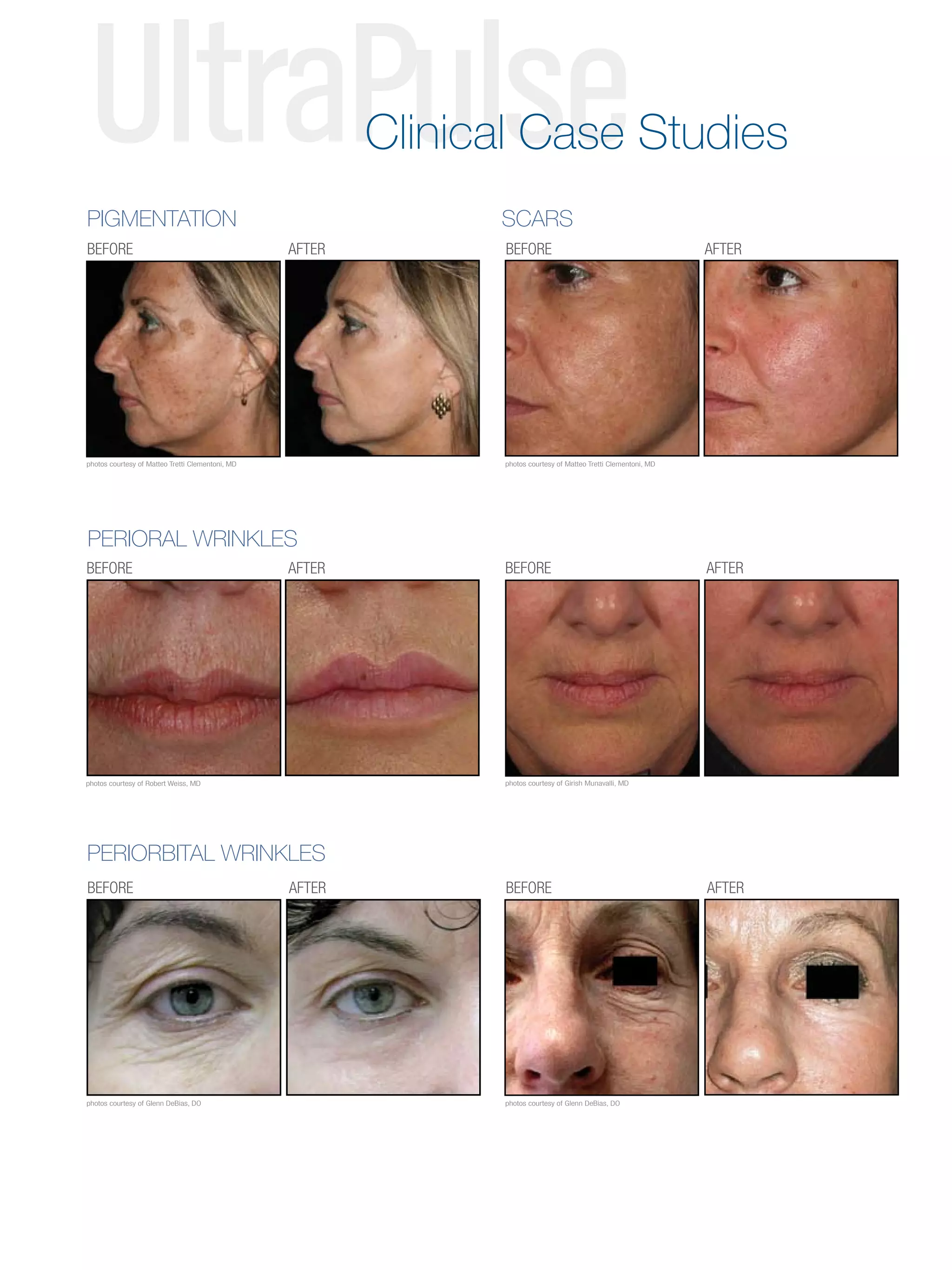 Ultra pulse encore | PDF