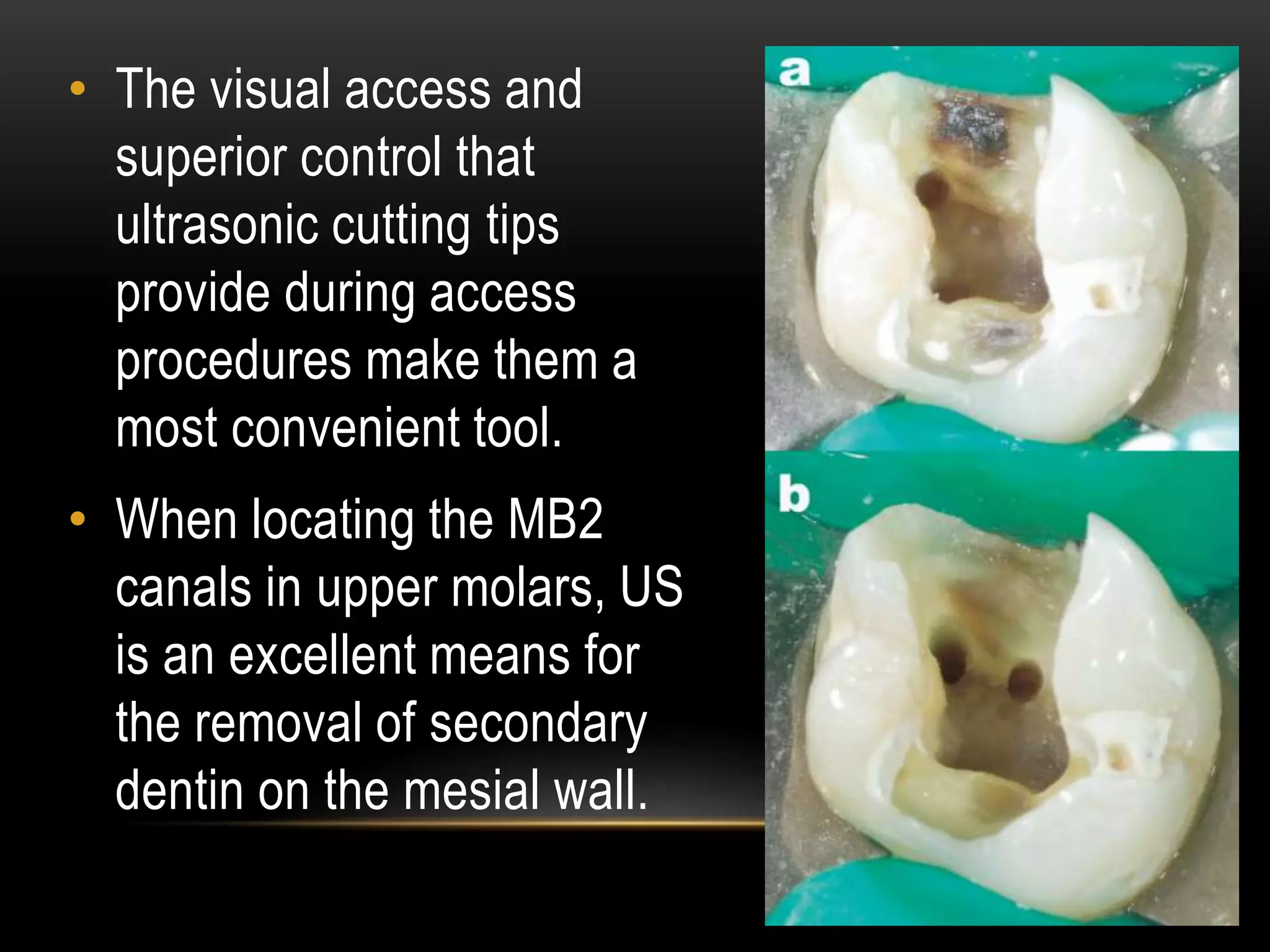 Ultrasonics in endodontics | PPTX