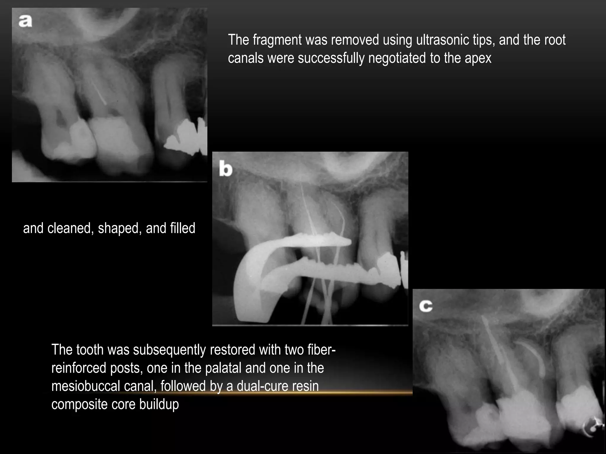 Ultrasonics in endodontics | PPTX