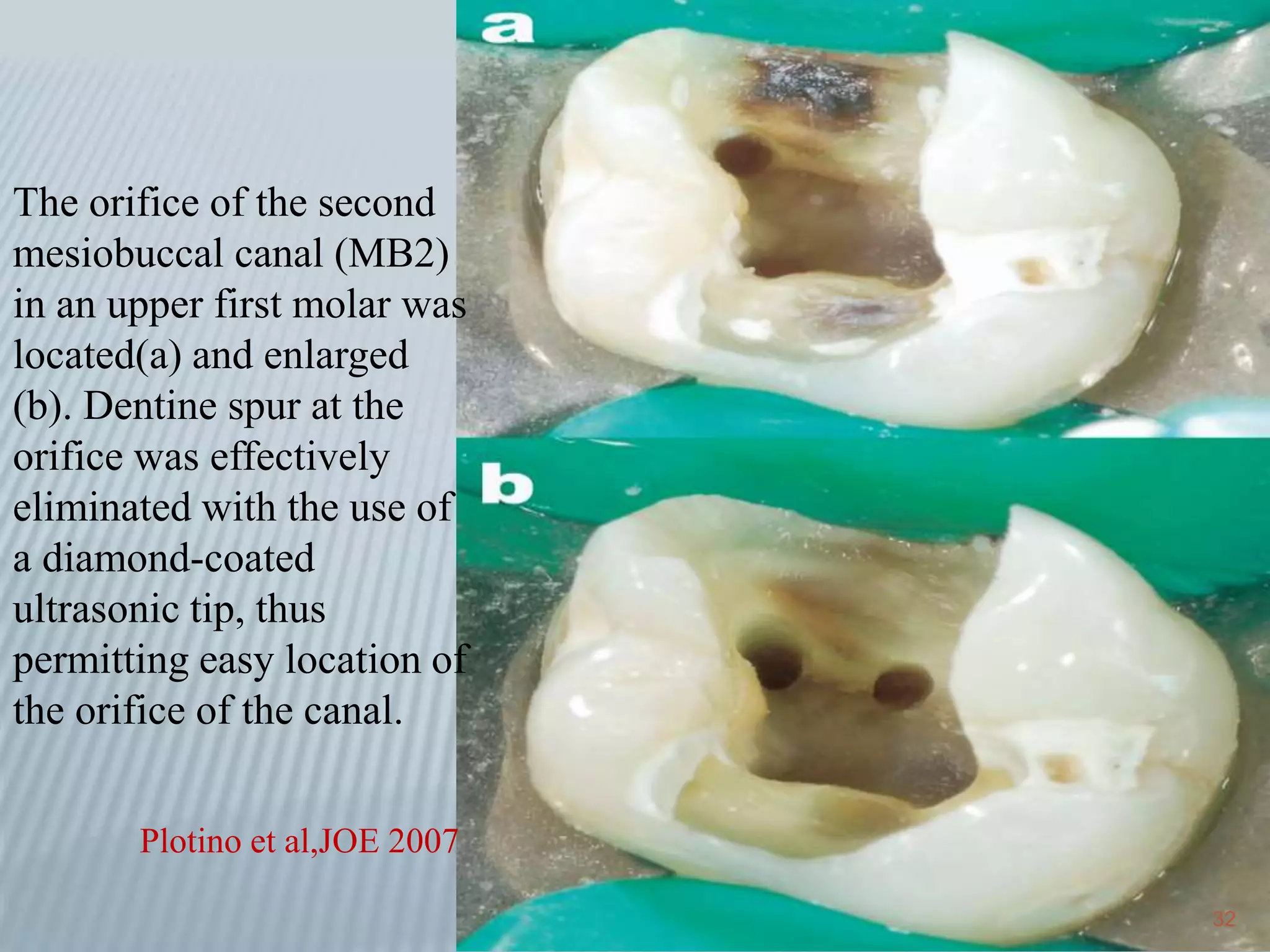 Ultrasonics endodontic tips | PPTX