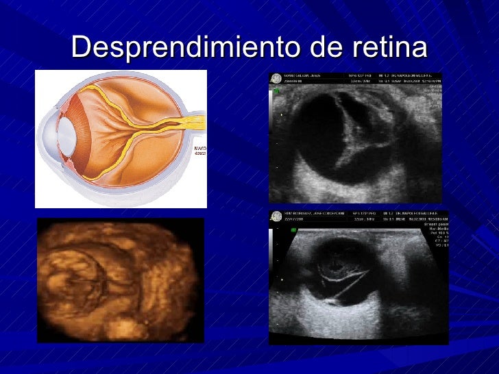 Ultrasonido y Doppler Ocular