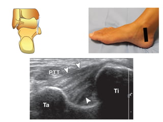 Ultrasonido de tobillo anatomía | PDF