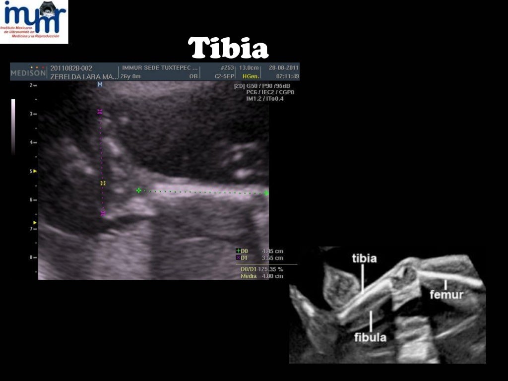 Ultrasonido en el crecimiento fetal normal y anormal. dr. romel