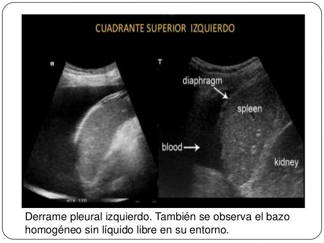 Ultrasonido FAST en Trauma