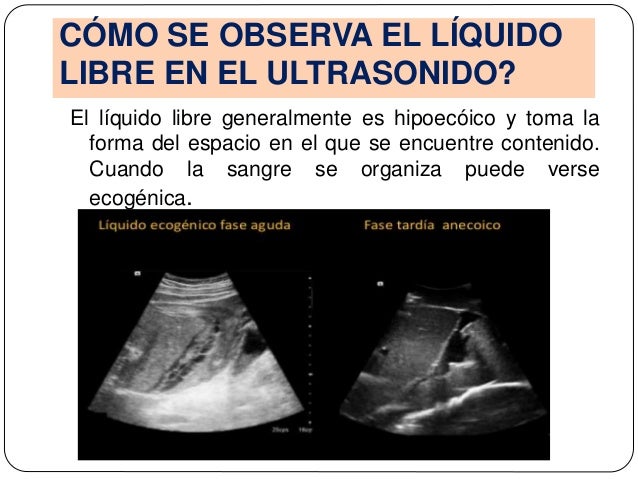 Ultrasonido FAST en Trauma