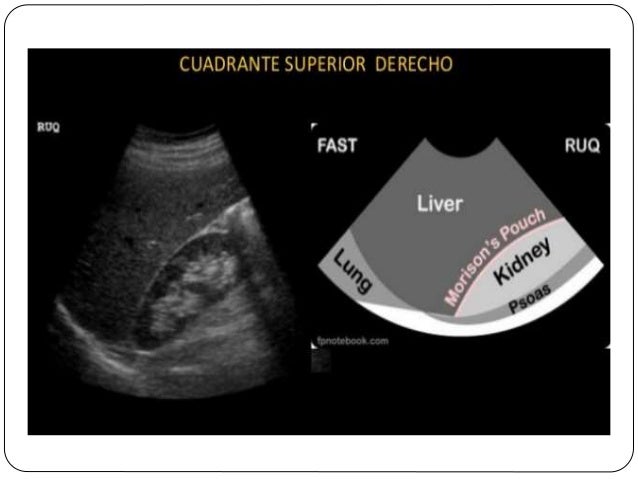 Ultrasonido FAST en Trauma
