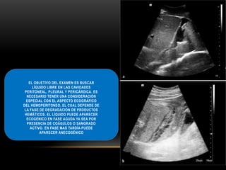 ULTRASONIDO FAST (FOCUSED ABDOMINAL SONOGRAPHY FOR TRAUMA.pptx