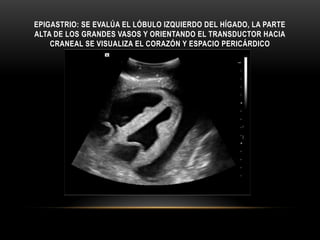 ULTRASONIDO FAST (FOCUSED ABDOMINAL SONOGRAPHY FOR TRAUMA.pptx