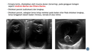 Ultrasonografi Okular yang Difokuskan pada Segmen Posterior Mata.pptx