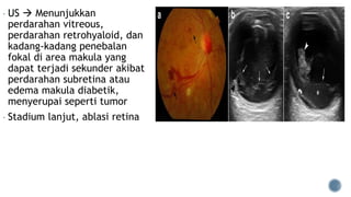 Ultrasonografi Okular yang Difokuskan pada Segmen Posterior Mata.pptx