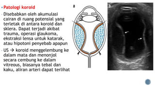 Ultrasonografi Okular yang Difokuskan pada Segmen Posterior Mata.pptx