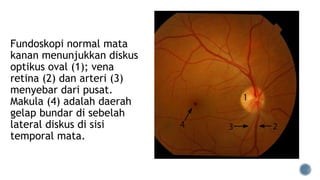 Ultrasonografi Okular yang Difokuskan pada Segmen Posterior Mata.pptx
