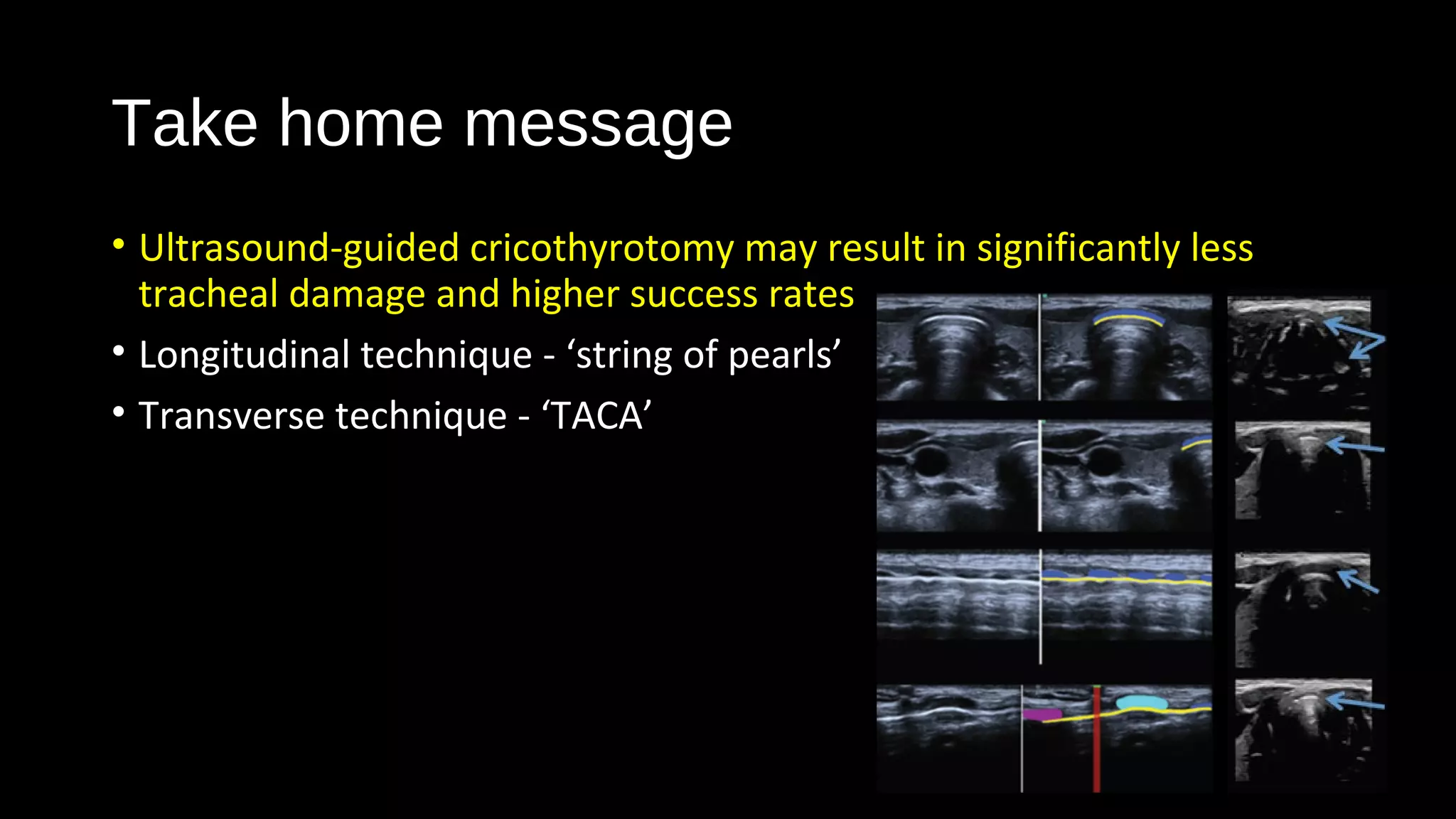 Ultrasonographic identification of the cricothyroid membrane and ...