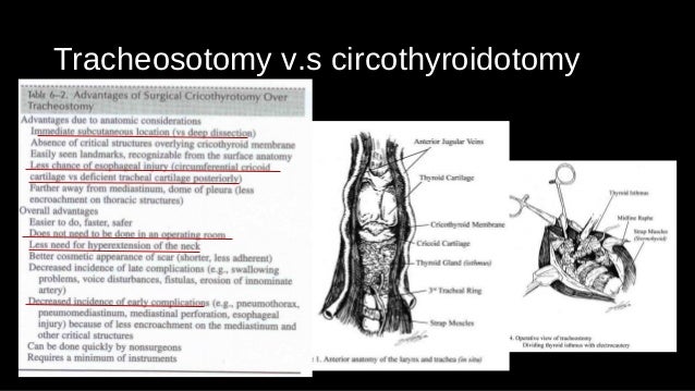 Ultrasonographic identification of the cricothyroid membrane and cric…