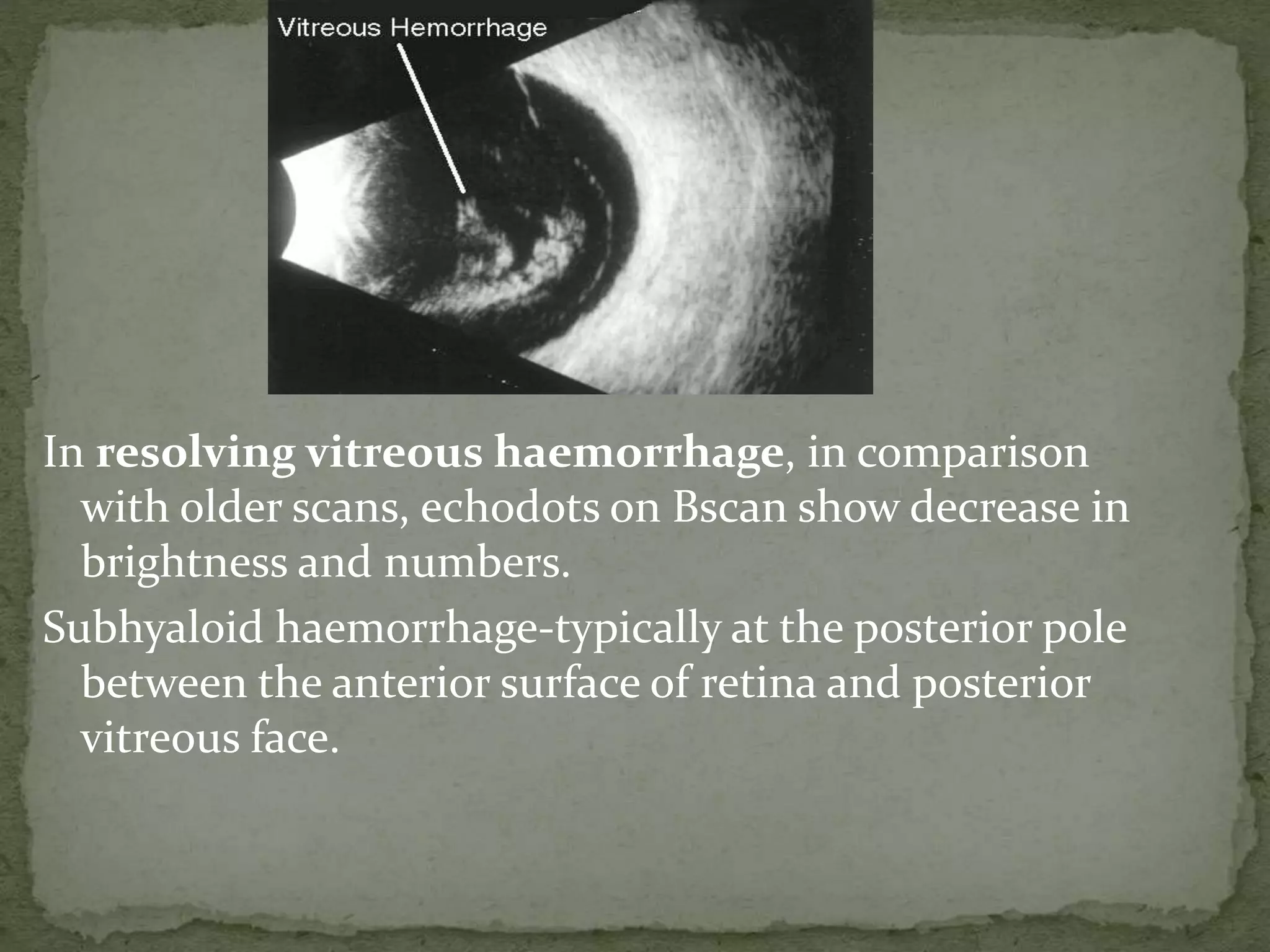 Ultrasonography in ophthalmology | PPTX