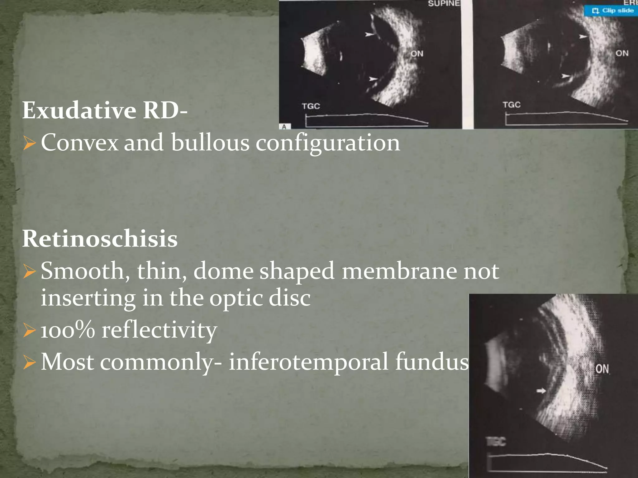 Ultrasonography in ophthalmology | PPTX