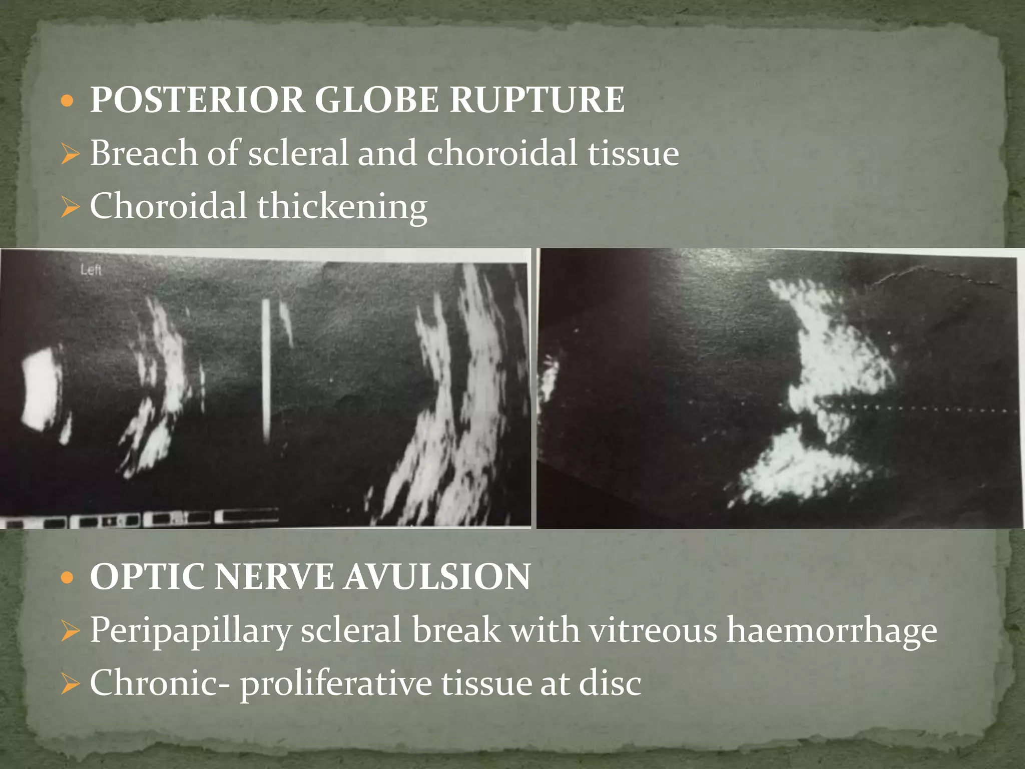 Ultrasonography in ophthalmology | PPTX