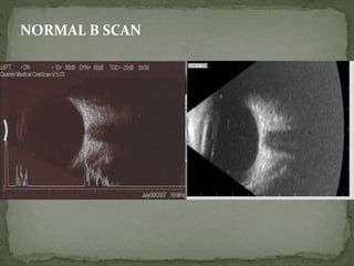 Ultrasonography in ophthalmology | PPTX