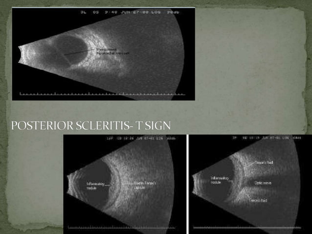 Ultrasonography in ophthalmology | PPTX | Eye and Vision Conditions ...