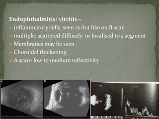 Vitritis B Scan